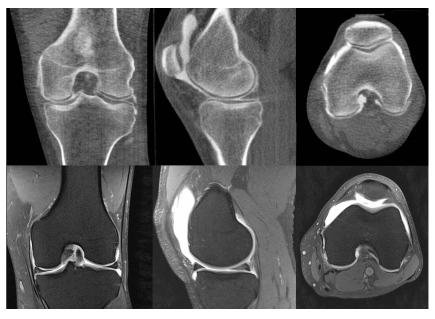 Case Study: Standing CT for Improved Visualization of Knee Cartilage ...