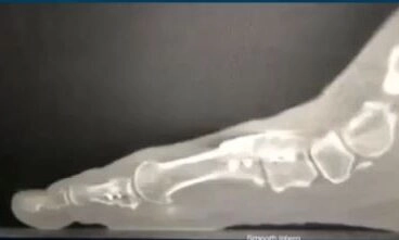 FOOTInnovate Webinar Recap: Application of Weightbearing CT (WBCT) in Common Foot & Ankle Disorders